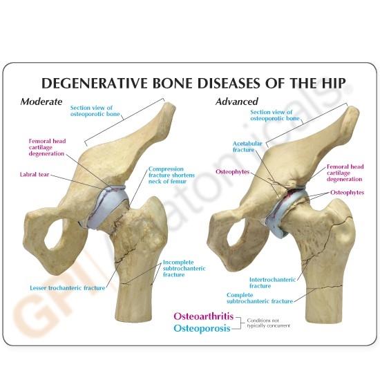 osteophytes hip