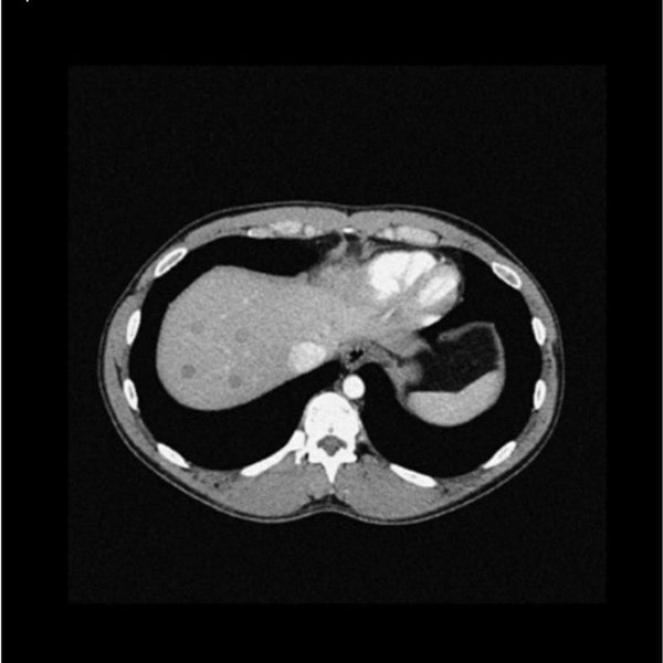 Low-Contrast Spheres Abdomen Phantom for CT Scan and X-Ray Training ...