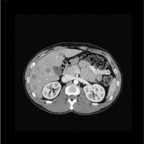 Low-Contrast Spheres Abdomen Phantom for CT Scan and X-Ray Training ...