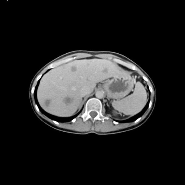 PV Liver Metastases Abdomen Phantom for CT Scan and X-Ray Training ...
