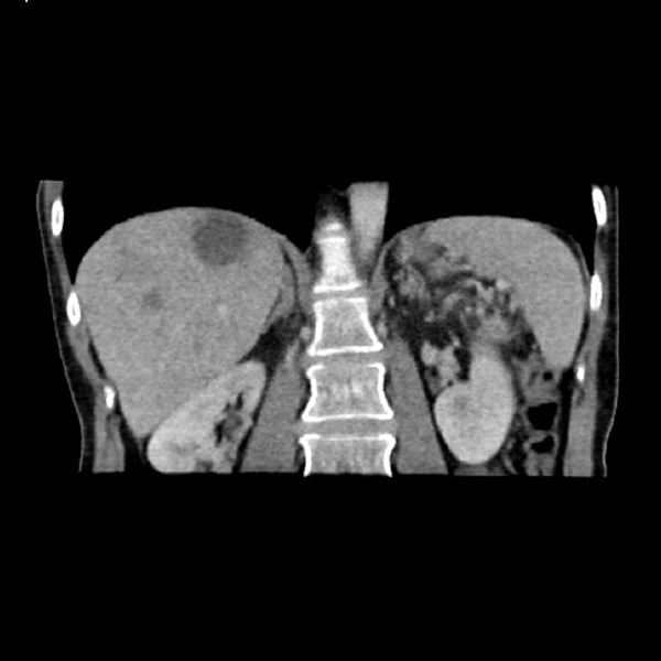 PV Liver Metastases Abdomen Phantom for CT Scan and X-Ray Training ...