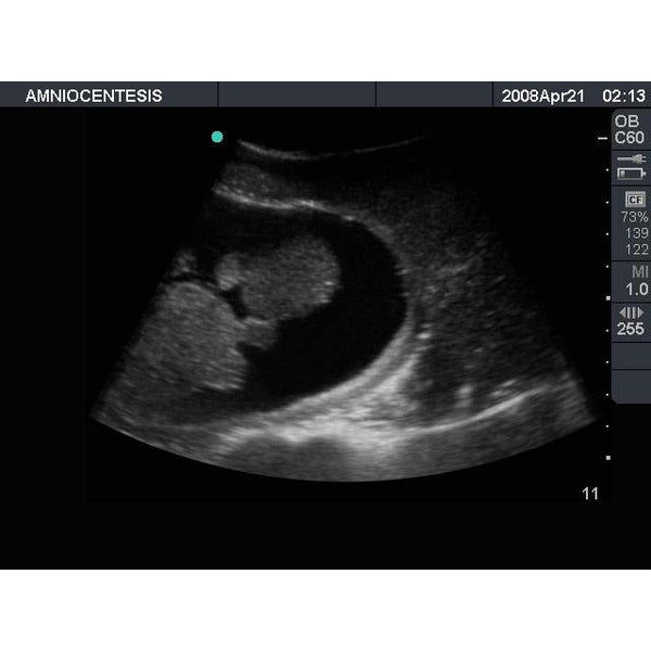 Amniocentesis Ultrasound Training Model – GTSimulators.com