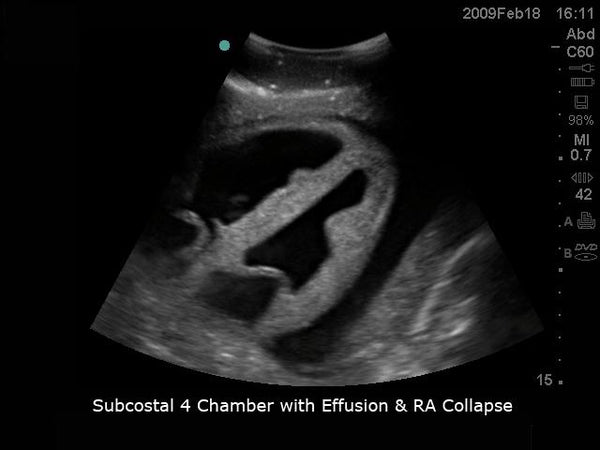 Cardiac Echo Ultrasound Training Model | CAE Blue Phantom ...