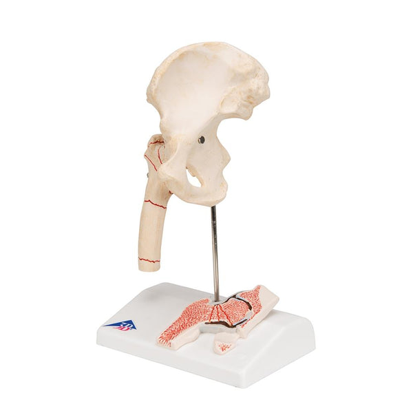 Femoral Fracture and Hip Osteoarthritis Model – GTSimulators.com
