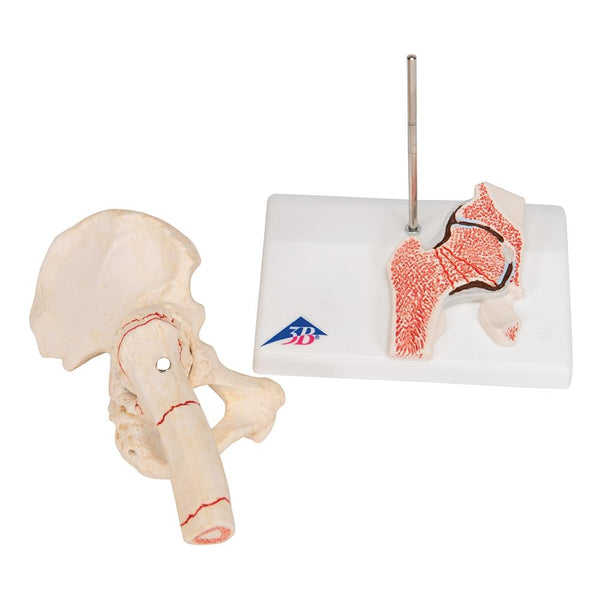 Femoral Fracture and Hip Osteoarthritis Model – GTSimulators.com