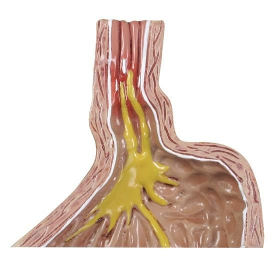 GastroEsophageal Reflux Disease Model (GERD) GP2010 – GTSimulators.com