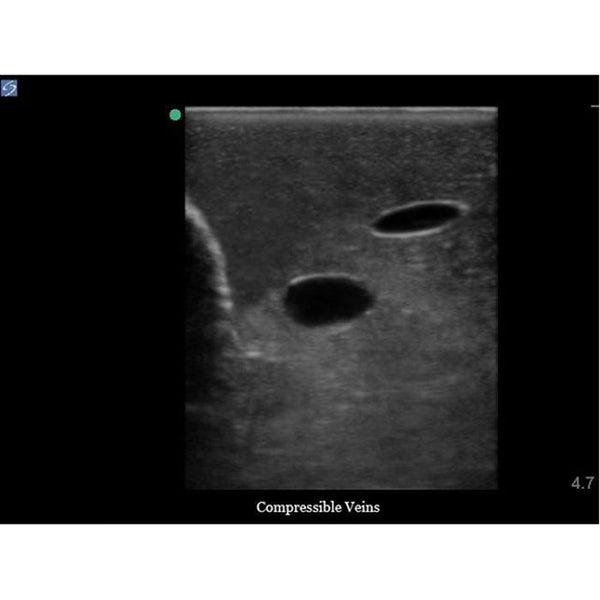 Gen II Ultrasound Central Line Training Model | CAE Blue Phantom ...