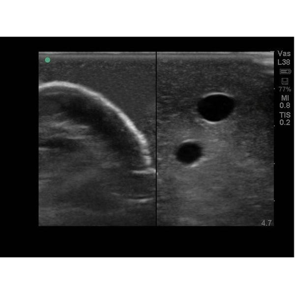 Gen II Ultrasound Central Line Training Model | CAE Blue Phantom ...