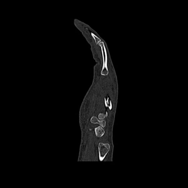 Hand Phantom Metacarpal Fractures for CT Scan and X-Ray Training ...