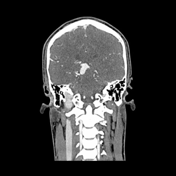 Head and Neck CTA Phantom AVM for CT Scan and X-Ray Training ...