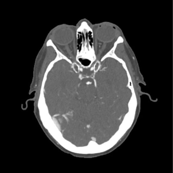 CTA Aneurysm Head Phantom for CT Scan and X-Ray Training – GTSimulators.com