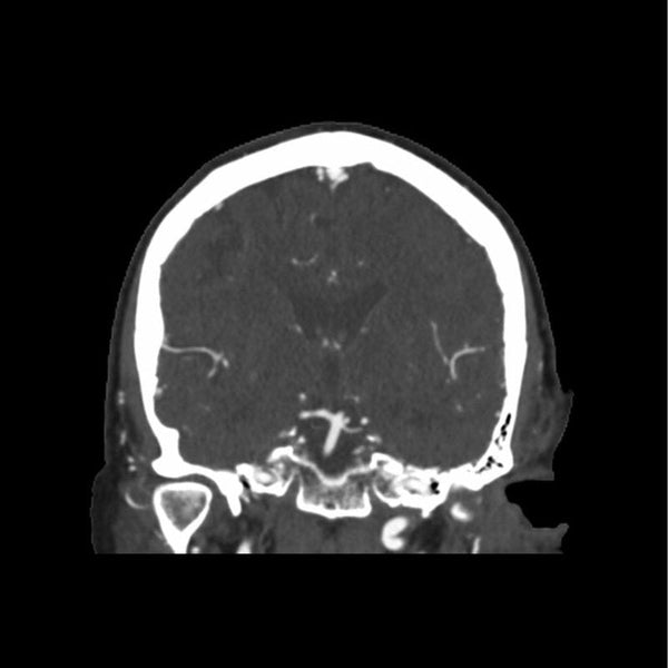 CTA Aneurysm Head Phantom for CT Scan and X-Ray Training – GTSimulators.com