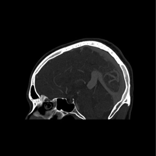 CTA AVM Head Phantom for CT Scan and X-Ray Training – GTSimulators.com