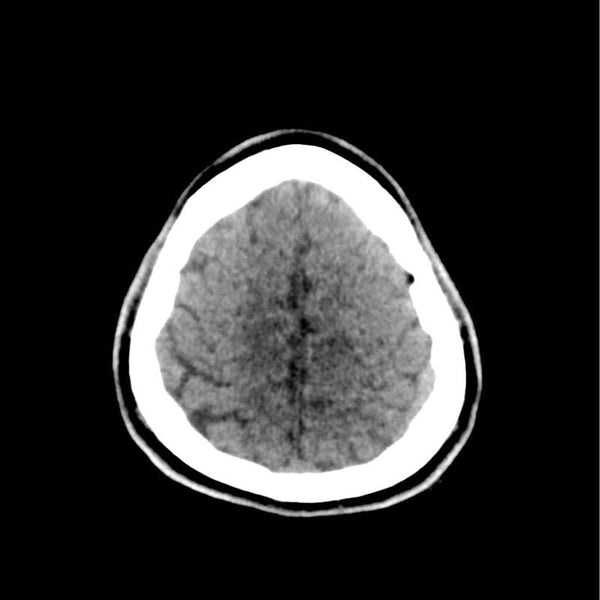 Stroke / Bleed Head Phantom for CT Scan and X-Ray Training ...