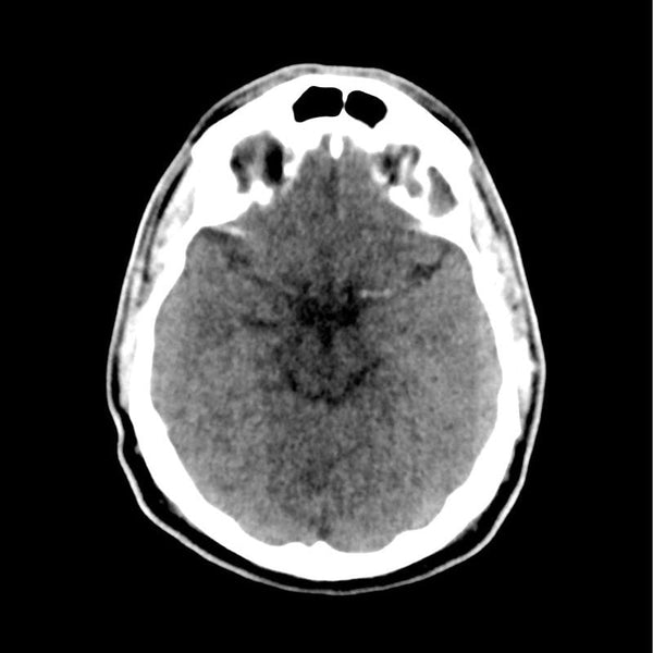 Stroke / Bleed Head Phantom for CT Scan and X-Ray Training ...