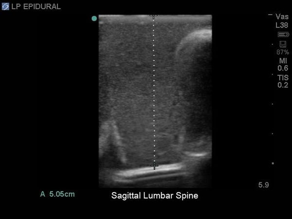 Lumbar Puncture and Spinal Epidural Training Model | CAE Blue Phantom ...