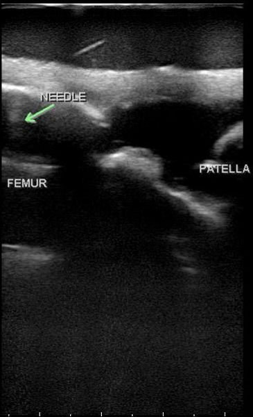 MSK Knee Ultrasound Training Model – GTSimulators.com