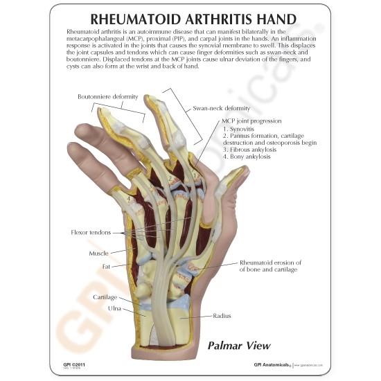 Rheumatoid Arthritis (RA) Hand Model – GTSimulators.com