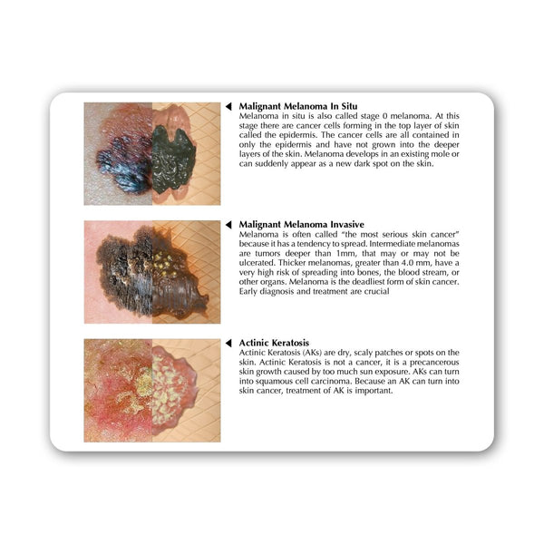 Skin Cancer Model – GTSimulators.com