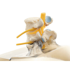 SOMSO Disc Models – Tagged "Lumbar Spinal Column Models" – GTSimulators.com
