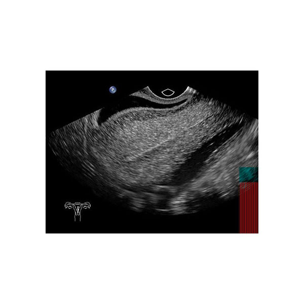 Sonohysterographay & Sonosalpingography Transvaginal Ultrasound Traini ...
