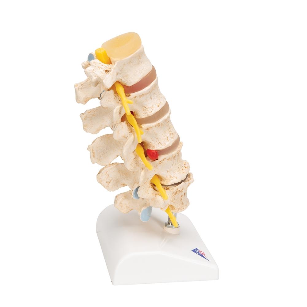 Stages of Disc Prolapse and Vertebral Degeneration Model – GTSimulators.com