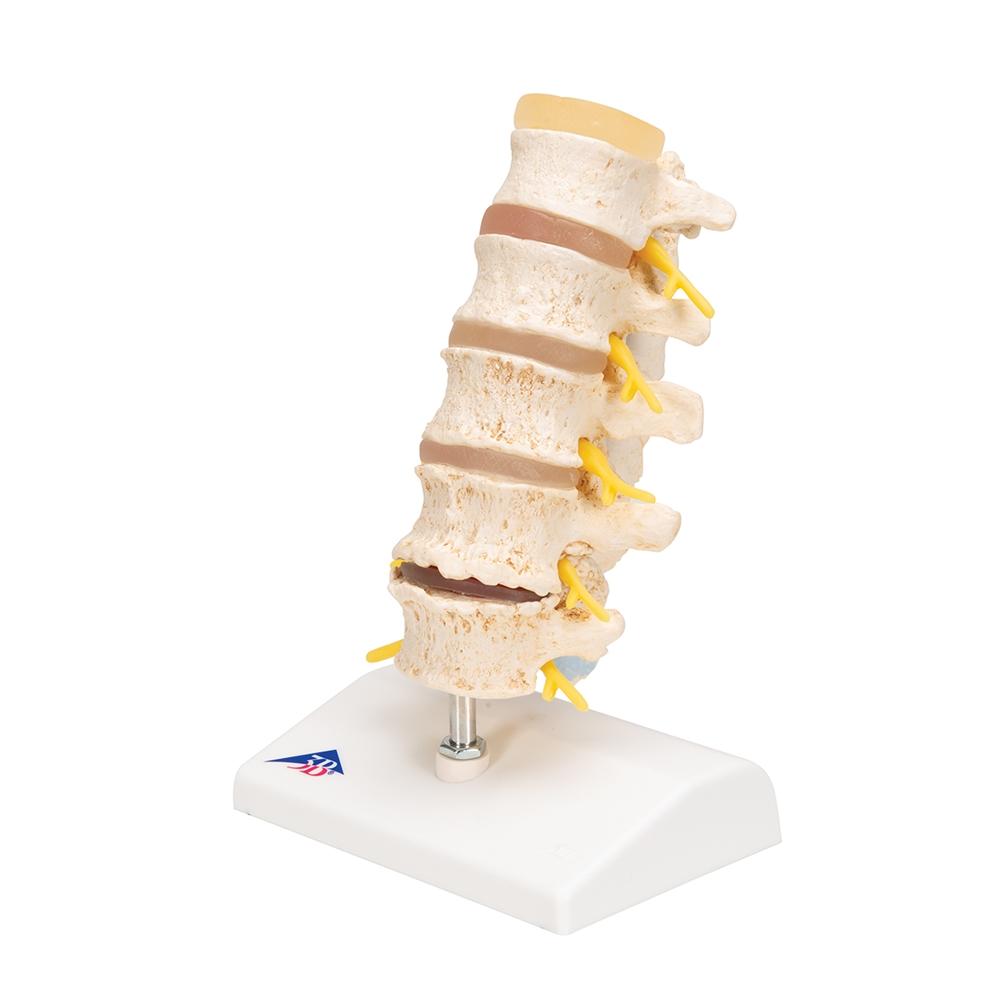 Stages of Disc Prolapse and Vertebral Degeneration Model – GTSimulators.com
