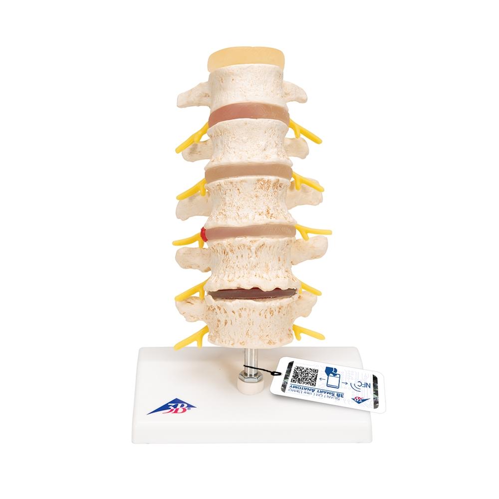 Stages of Disc Prolapse and Vertebral Degeneration Model – GTSimulators.com