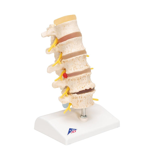 Stages of Disc Prolapse and Vertebral Degeneration Model – GTSimulators.com