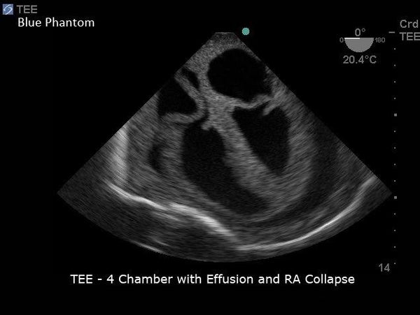 Transesophageal Echo and Transthoracic Echo Training Model | CAE Blue ...